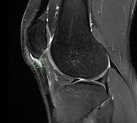 Patellar tendonitis